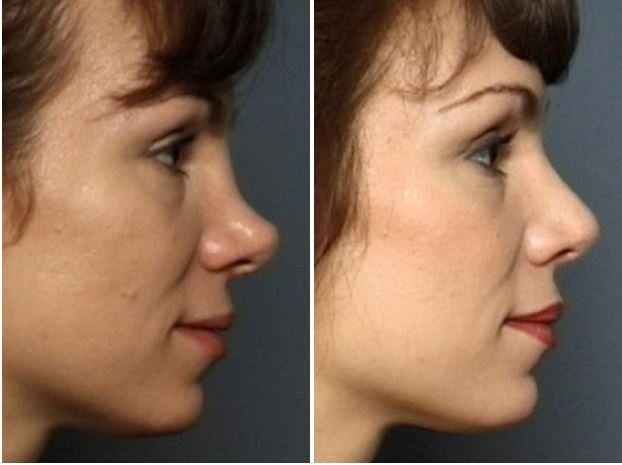 How To Reduce Size Of Nose Flatdisk24
