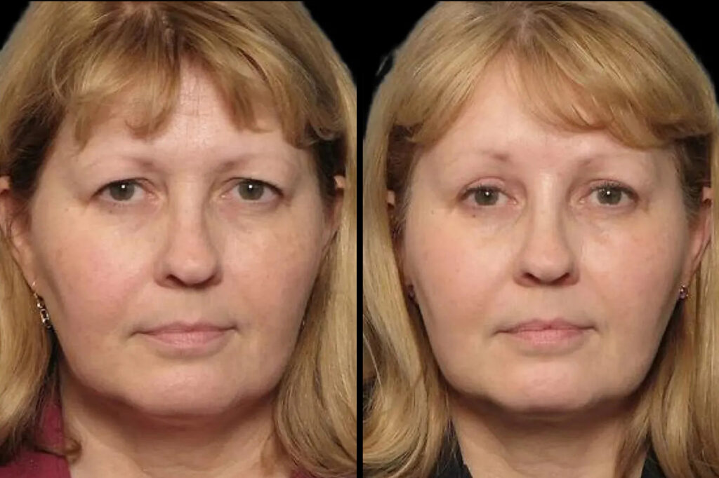 Blepharoplasty 1 - Stein Plastic Surgery