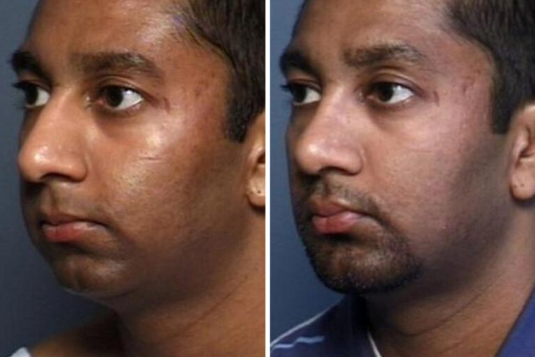 Chin Augmentation 1 - Stein Plastic Surgery