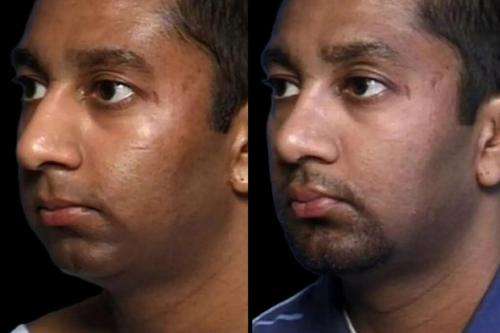 What is the Best Treatment for a Double Chin? - Stein Plastic Surgery