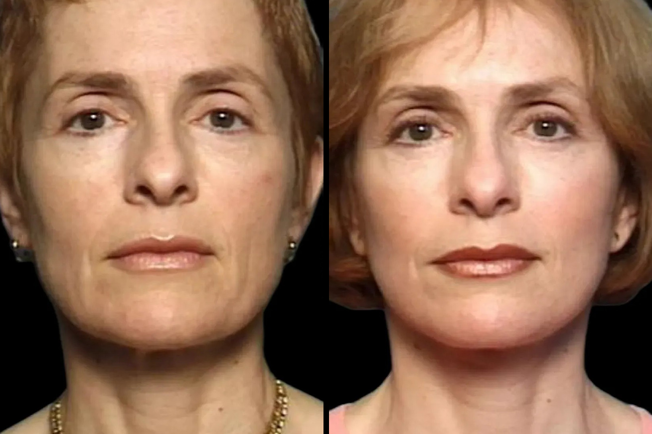 Facelift 2 - Stein Plastic Surgery